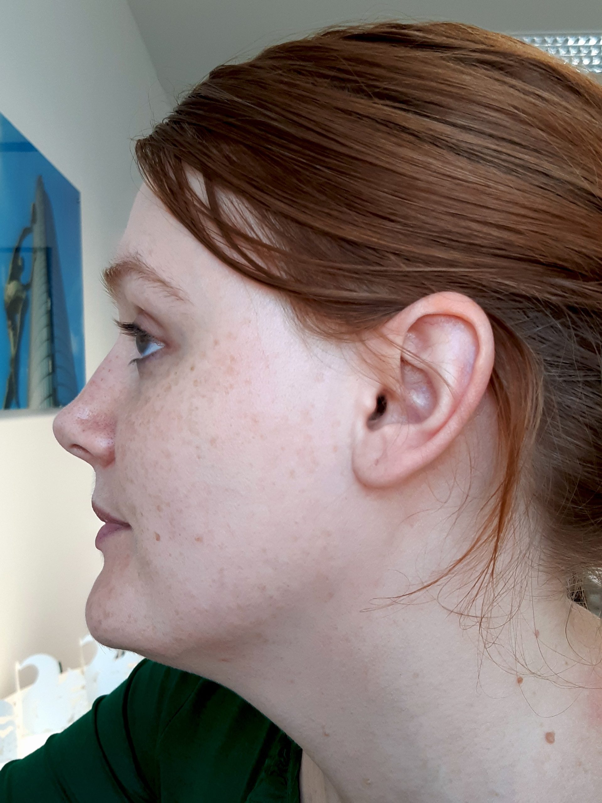Want to Know How to Cure Melasma from the Inside? Read This